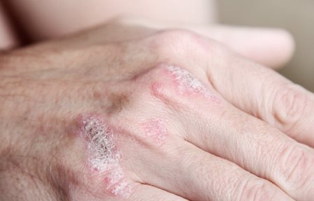 Psoriasis: symptomen, oorzaken & oplossingen | Eucerin